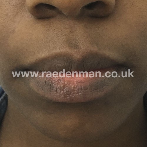 Lack of Pigment/Hypo-pigmentation London | Surrey - Rae Denman