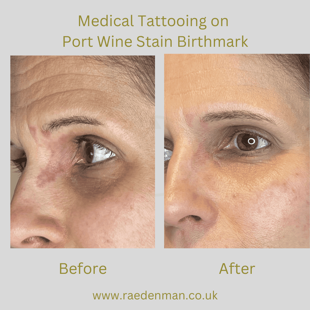 Patient testimonial - my port wine birthmark and medical tattooing ...